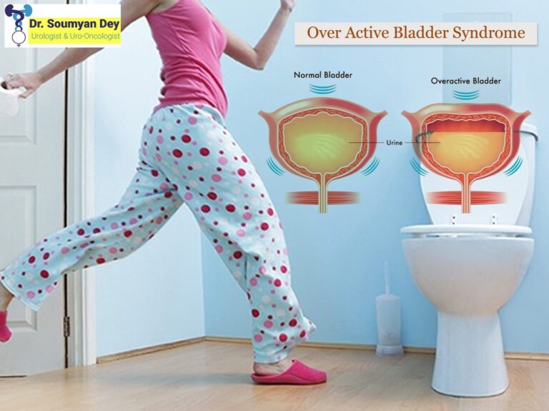 Symptoms Causes & Treatment of Overactive Bladder Syndrome