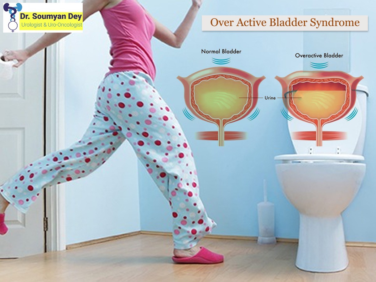 Symptoms Causes Treatment Of Overactive Bladder Syndrome Symptoms Causes Treatment Of Overactive Bladder Syndrome