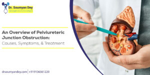 Pelviureteric Junction Obstruction: Causes, Symptoms, & Treatment
